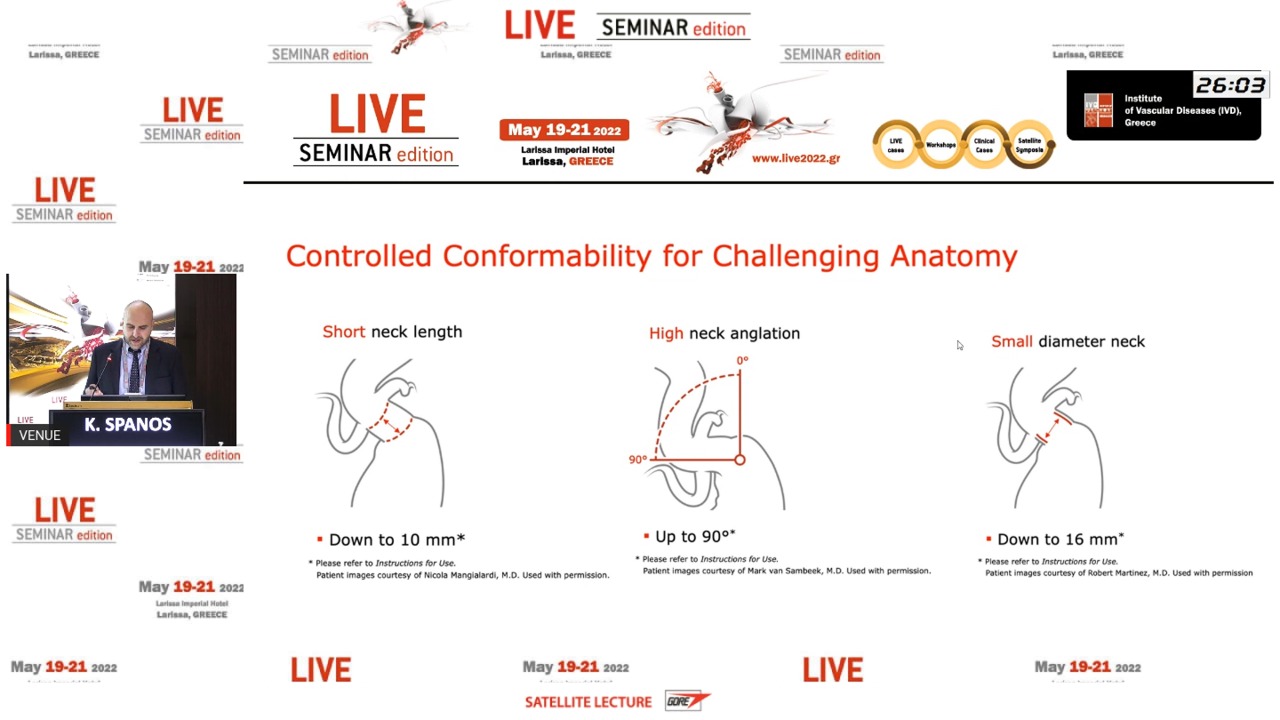 K. Spanos | Endovascular treatment of AAA with angulated neck ...